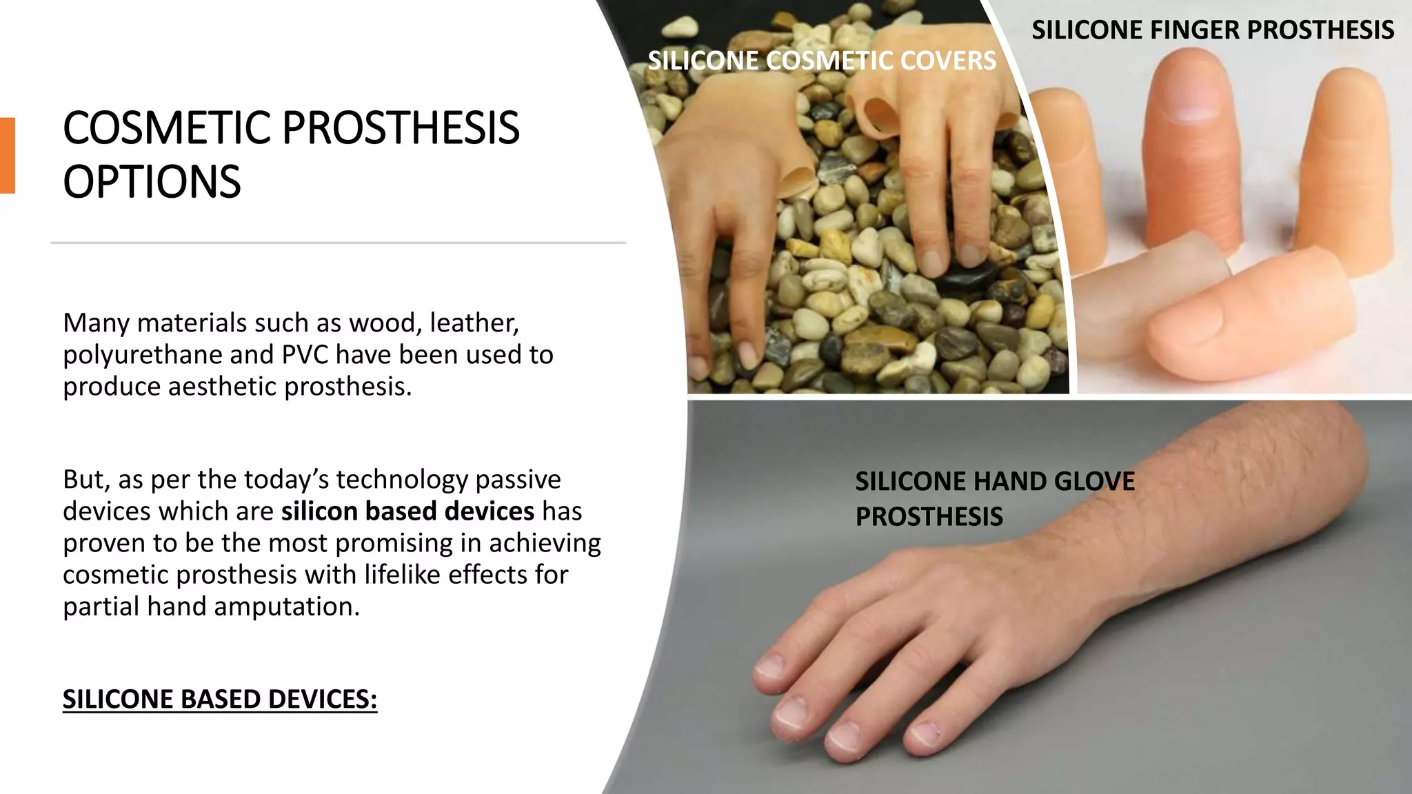 Cosmetic Restoration and silicone finger Prosthesis | PPTX