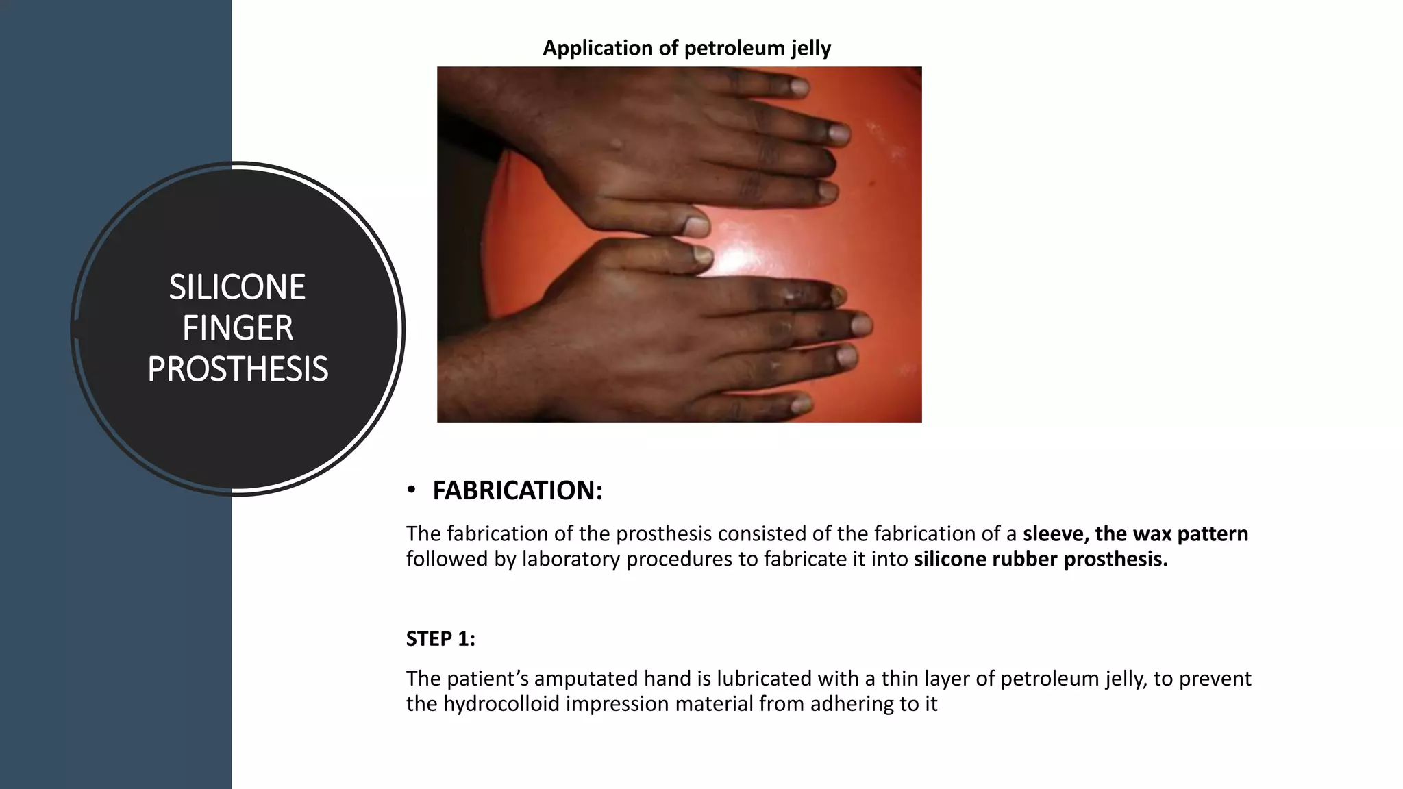 Cosmetic Restoration and silicone finger Prosthesis | PPTX