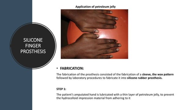 Cosmetic Restoration and silicone finger Prosthesis | PPTX | Nail Care ...