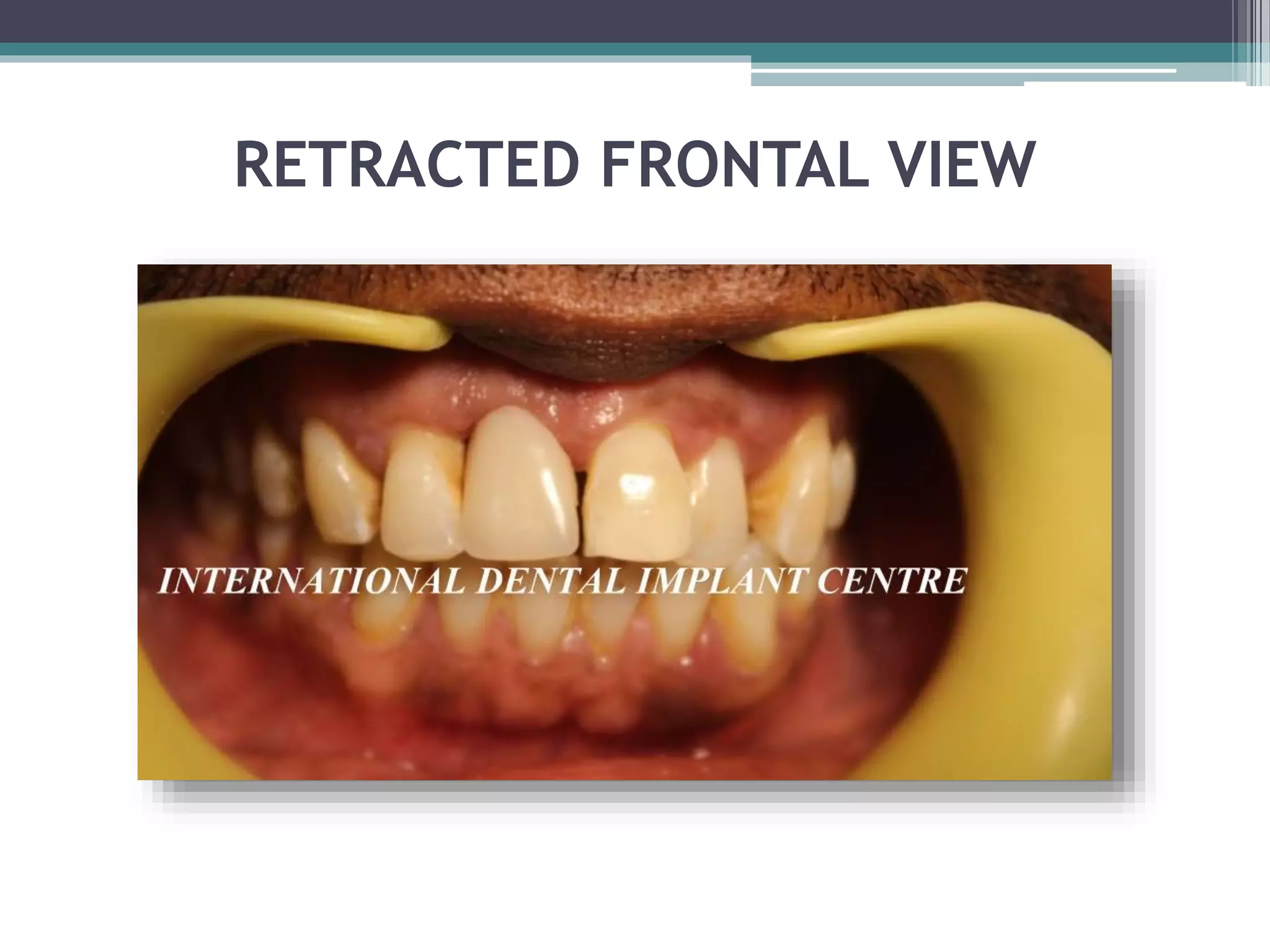Cosmetic rehabilitation of missing upper anterior tooth with immediate ...