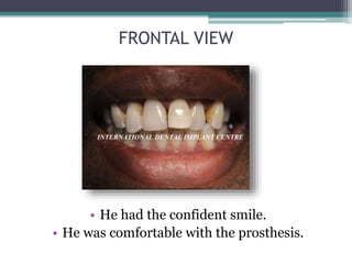 Cosmetic rehabilitation of missing upper anterior tooth with immediate ...