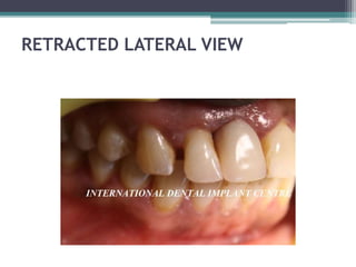 Cosmetic rehabilitation of missing upper anterior tooth with immediate ...
