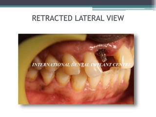 Cosmetic rehabilitation of missing upper anterior tooth with immediate ...