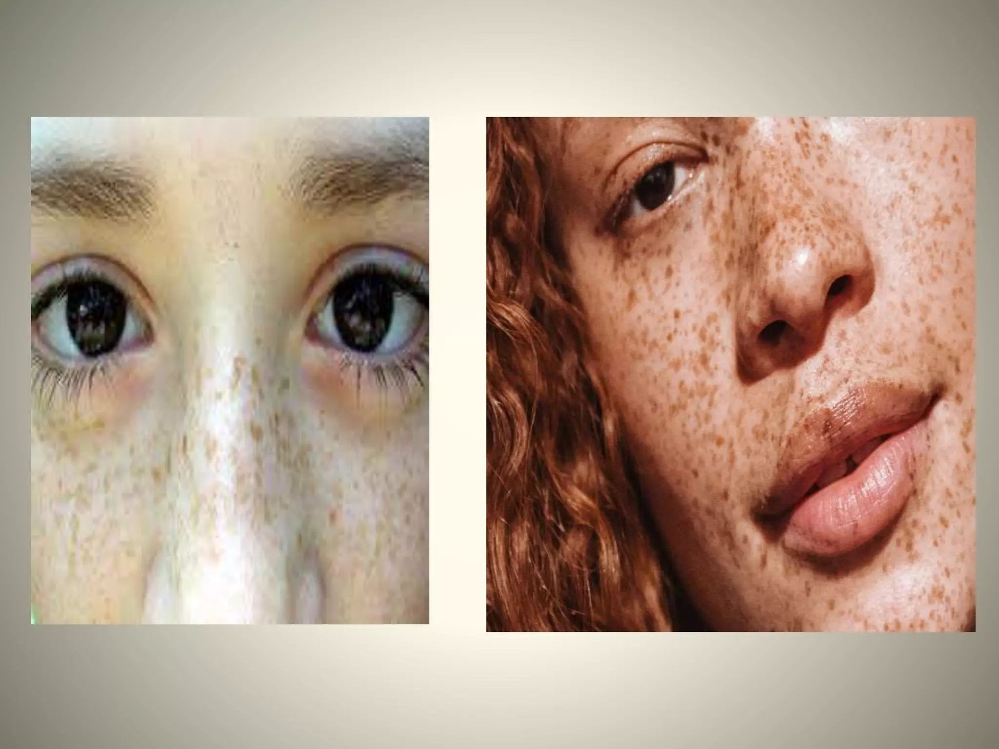 Structure of skin relating to problems like dry skin, acne vulgaris ...