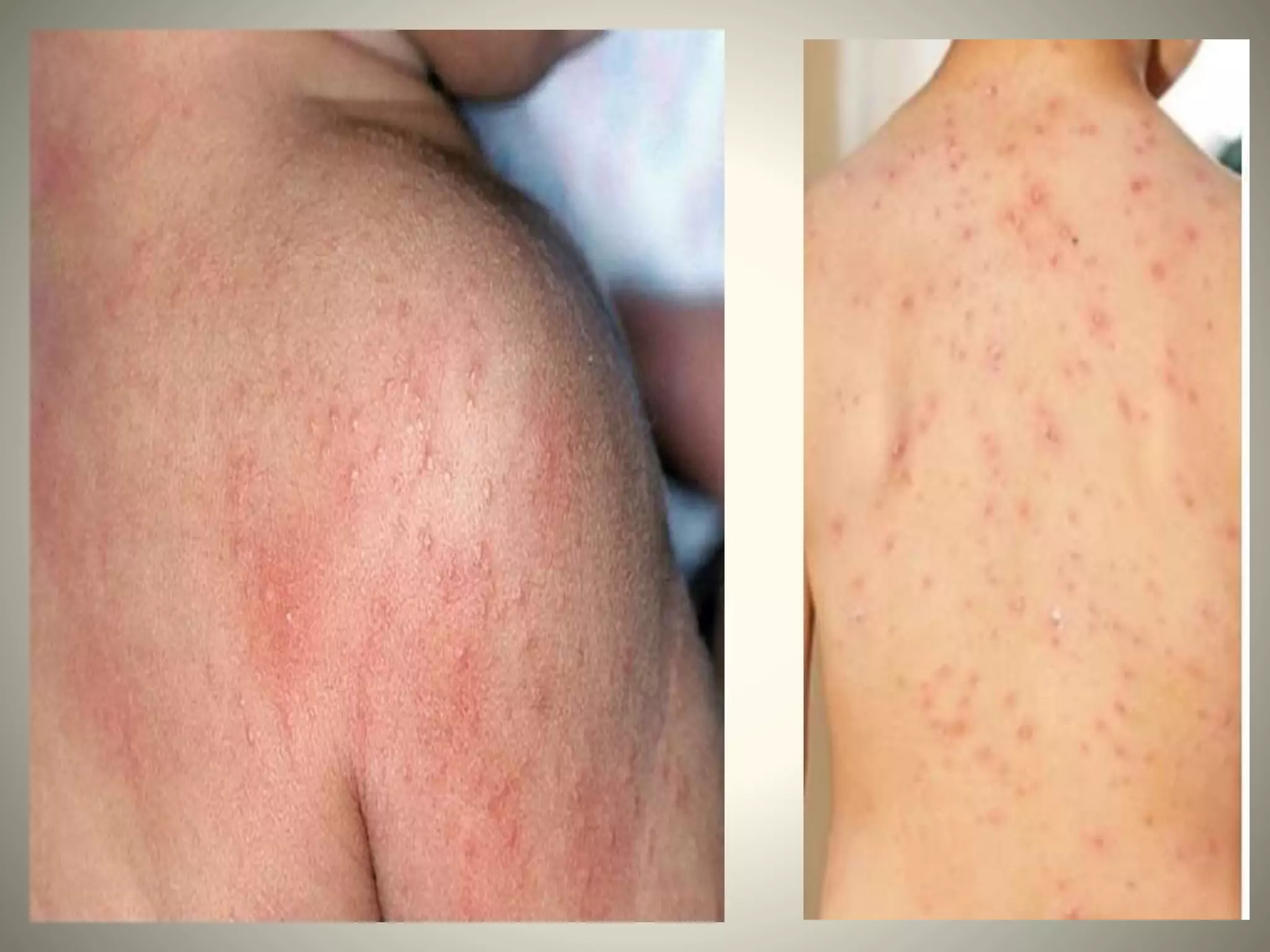 Structure of skin relating to problems like dry skin, acne vulgaris ...