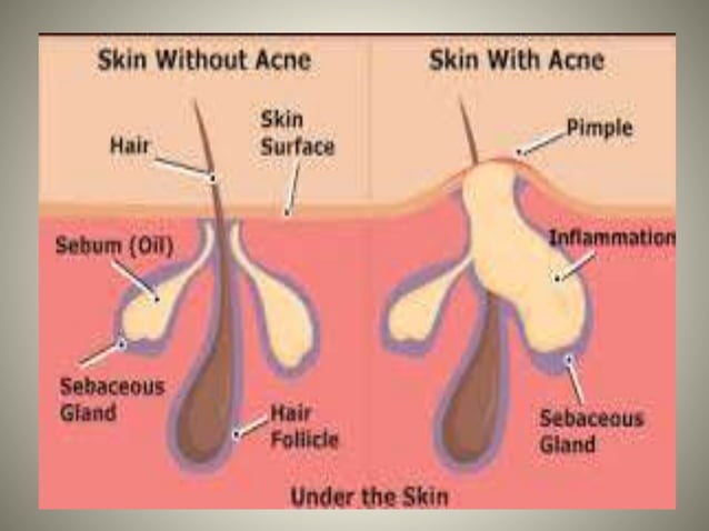 Structure of skin relating to problems like dry skin, acne vulgaris ...