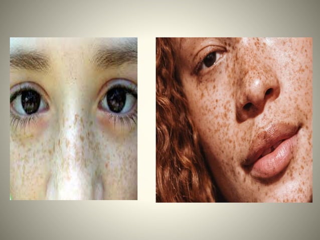 Structure of skin relating to problems like dry skin, acne vulgaris ...