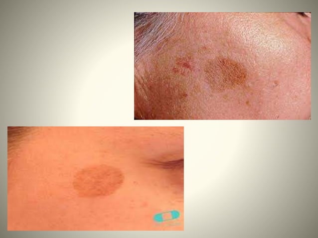 Structure of skin relating to problems like dry skin, acne vulgaris ...