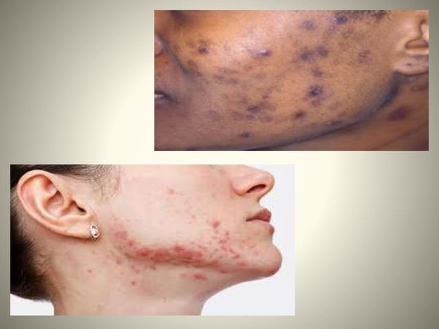 Structure of skin relating to problems like dry skin, acne vulgaris ...