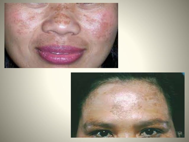 Structure of skin relating to problems like dry skin, acne vulgaris ...