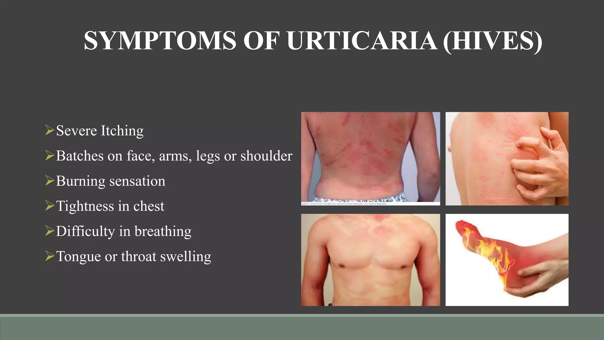 Hives( urticaria) , Cosmetology presentation , | PPTX
