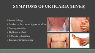 Hives( urticaria) , Cosmetology presentation , | PPT