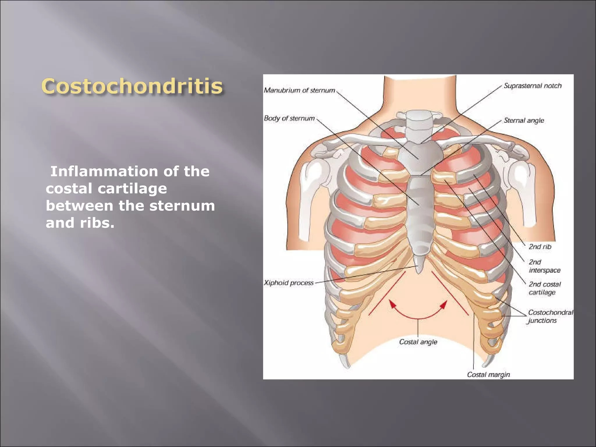 Costochondritis | PPT