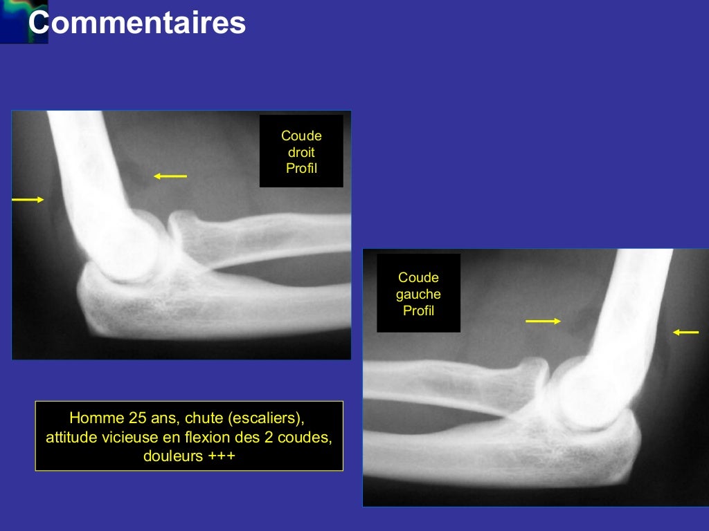 Cas pratique 1 : Coude
