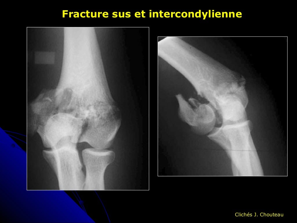 Coude fractures