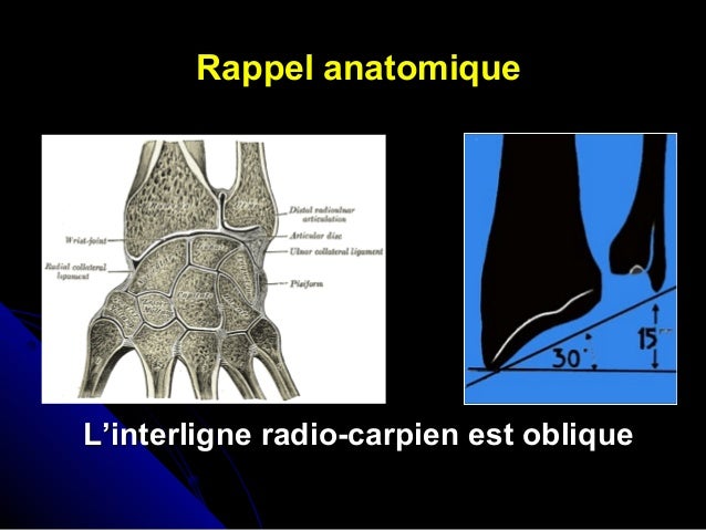 Coude fractures