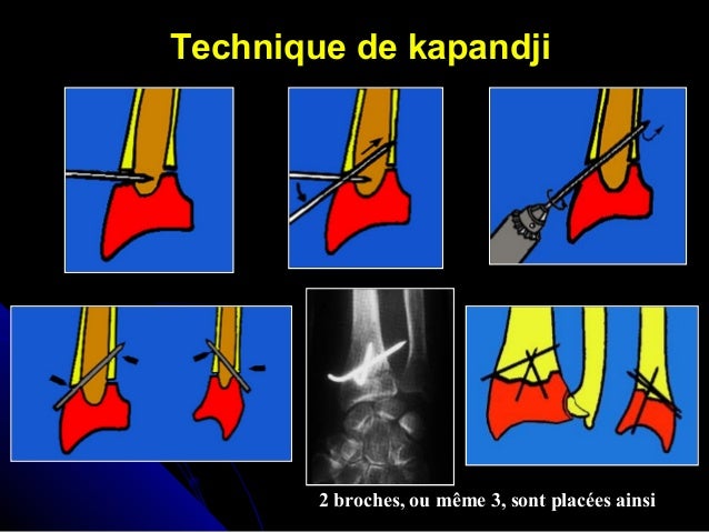 5 Les Possibilits D39opposition Du Pouce Kapandji 1986