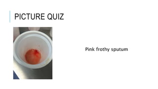 Pink Frothy Sputum