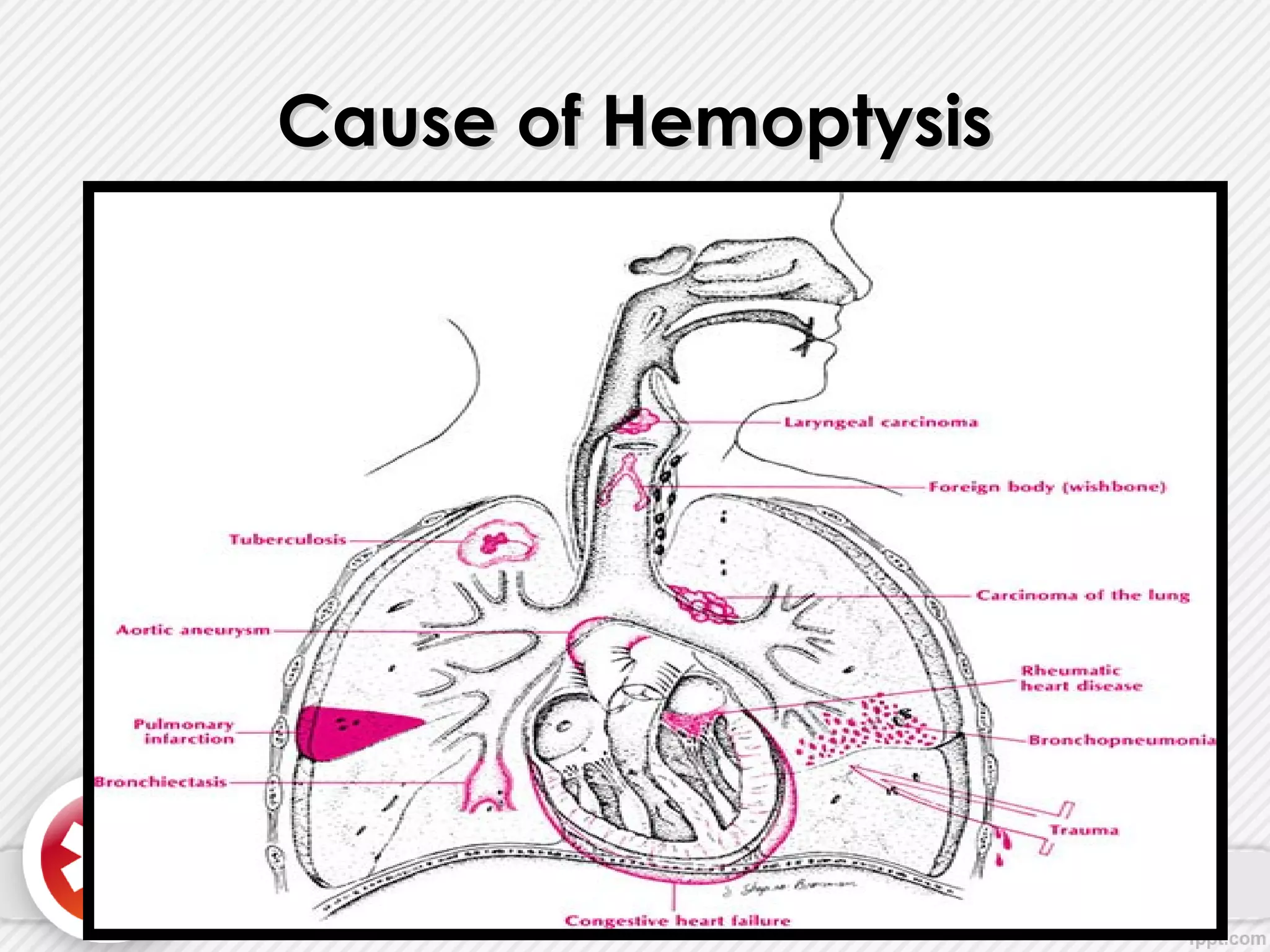 Cough , haemoptysis,lung cancer | PPT