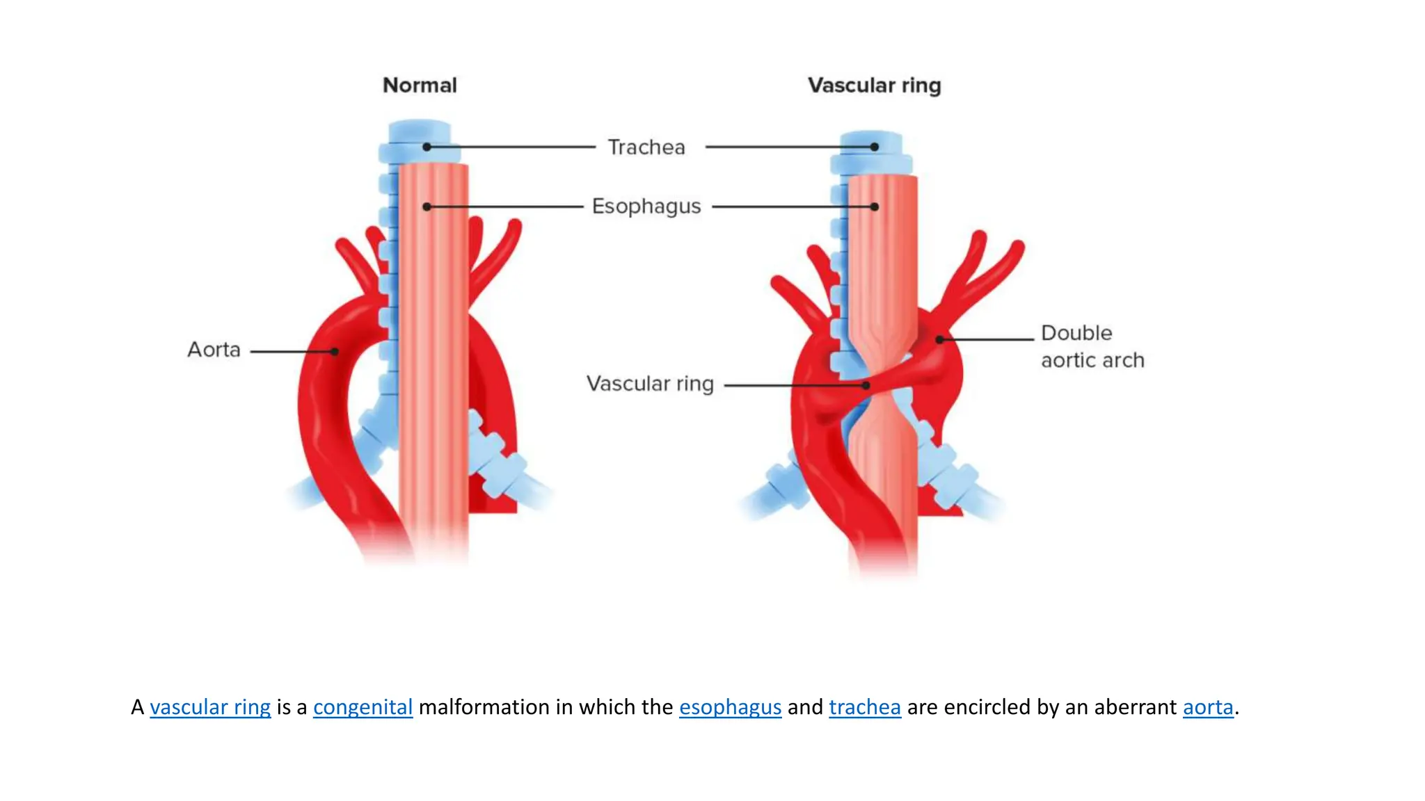 Cough in children.pptx by dr sayed ismail | PPTX