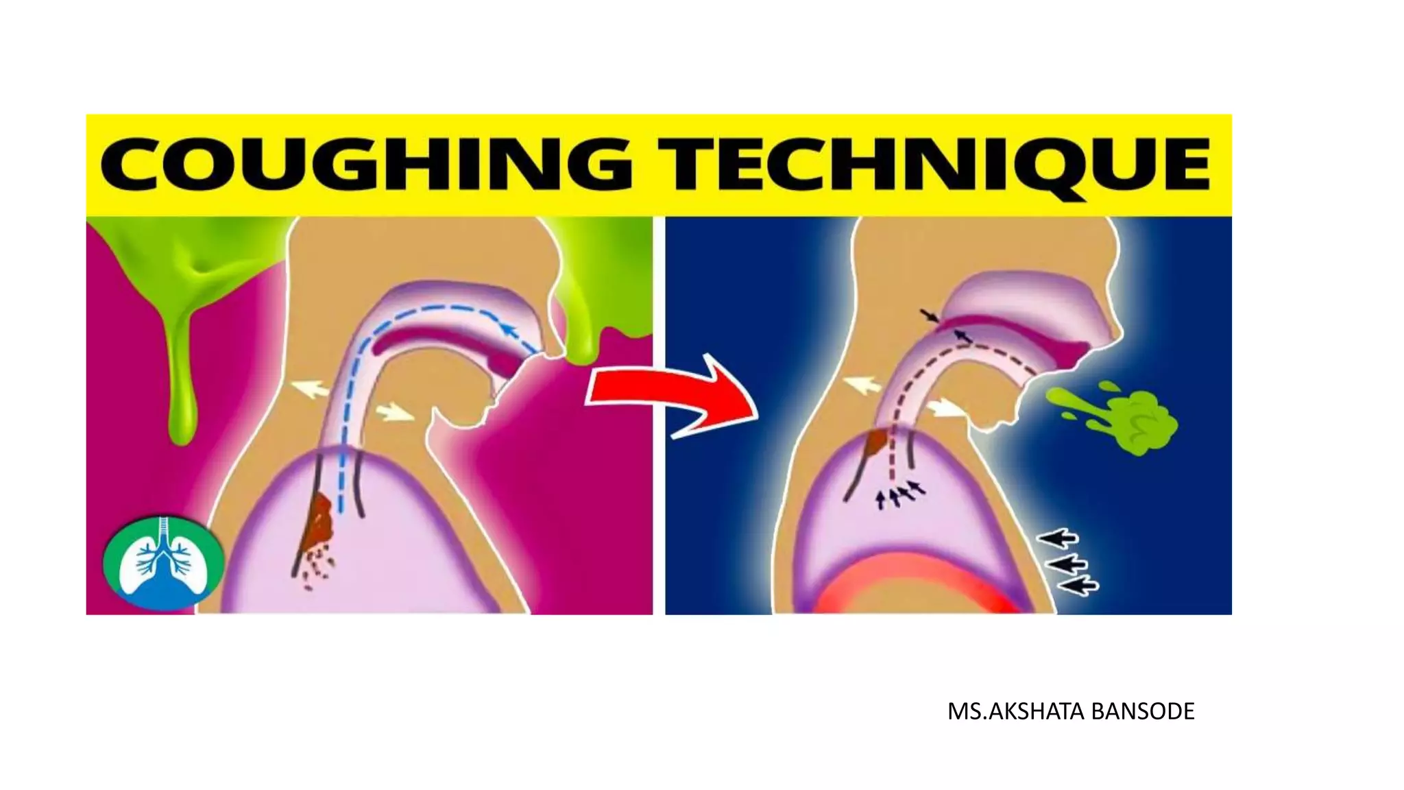 COUGHING TECHNIQUES.pptx
