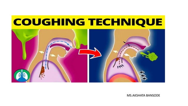 COUGHING TECHNIQUES.pptx | Physical Therapy | Wellness