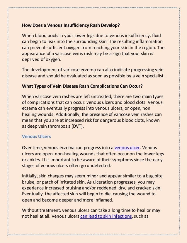 Could my varicose veins cause skin rashes | PDF