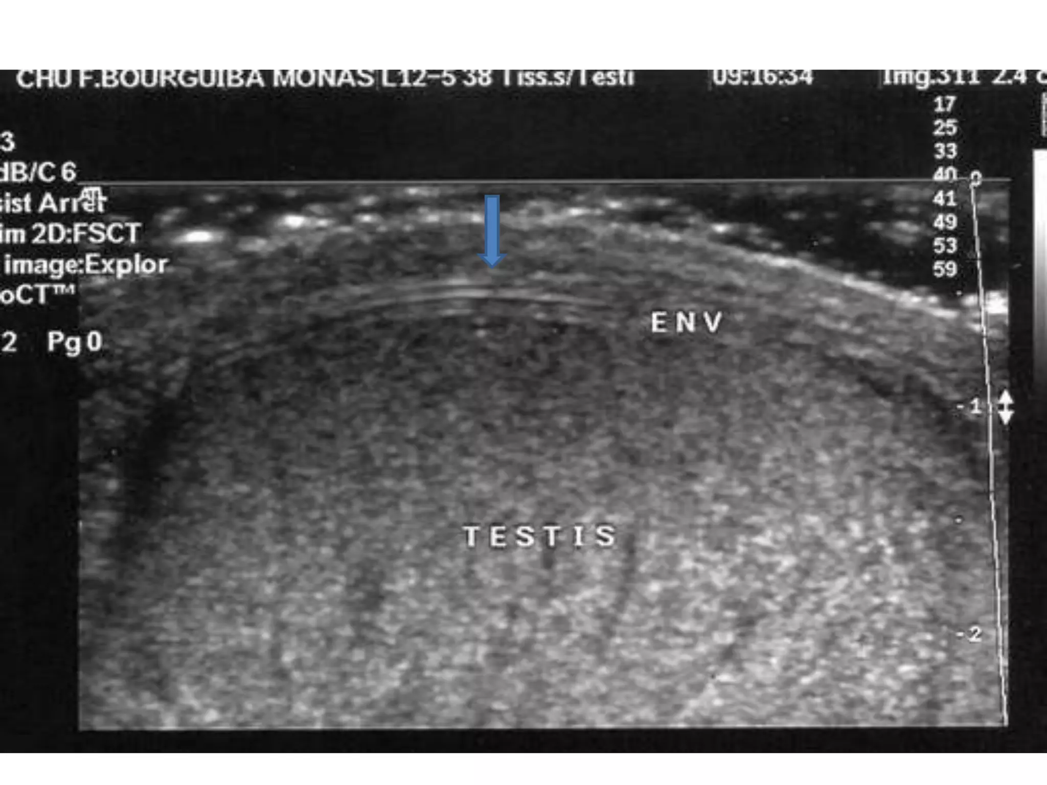SCROTAL ULTRASOUND | PPTX