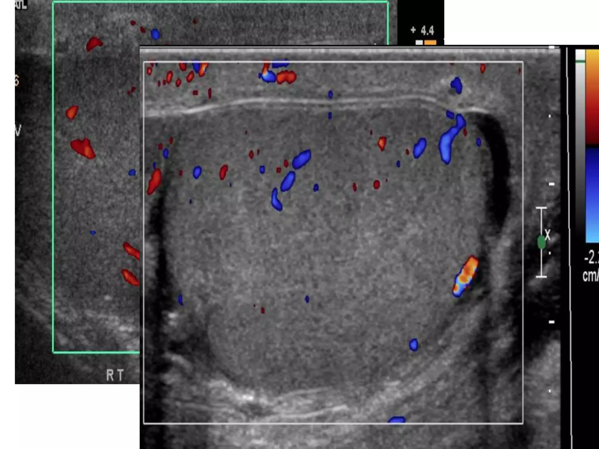 Scrotal Ultrasound Ppt