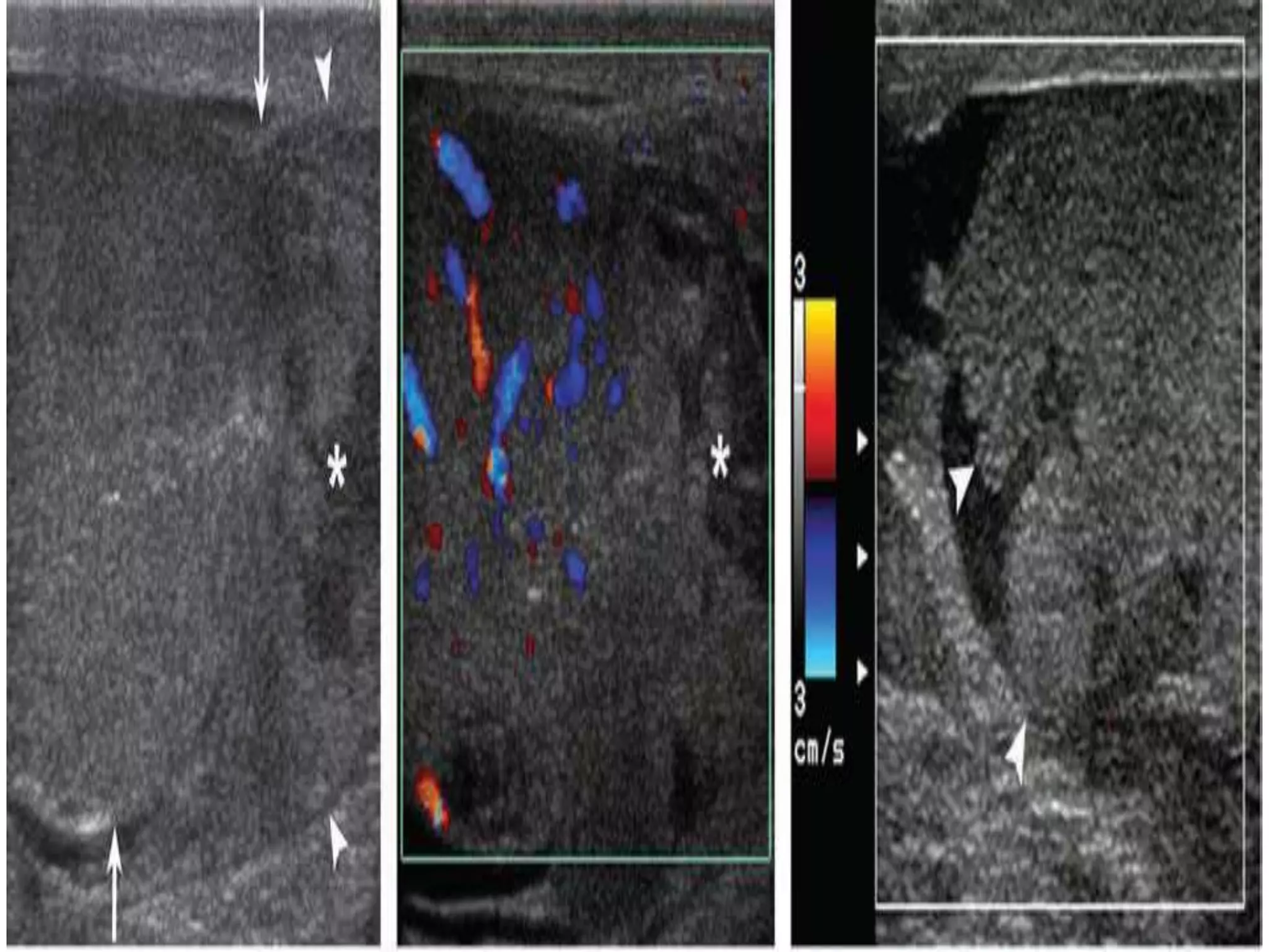 SCROTAL ULTRASOUND | PPTX