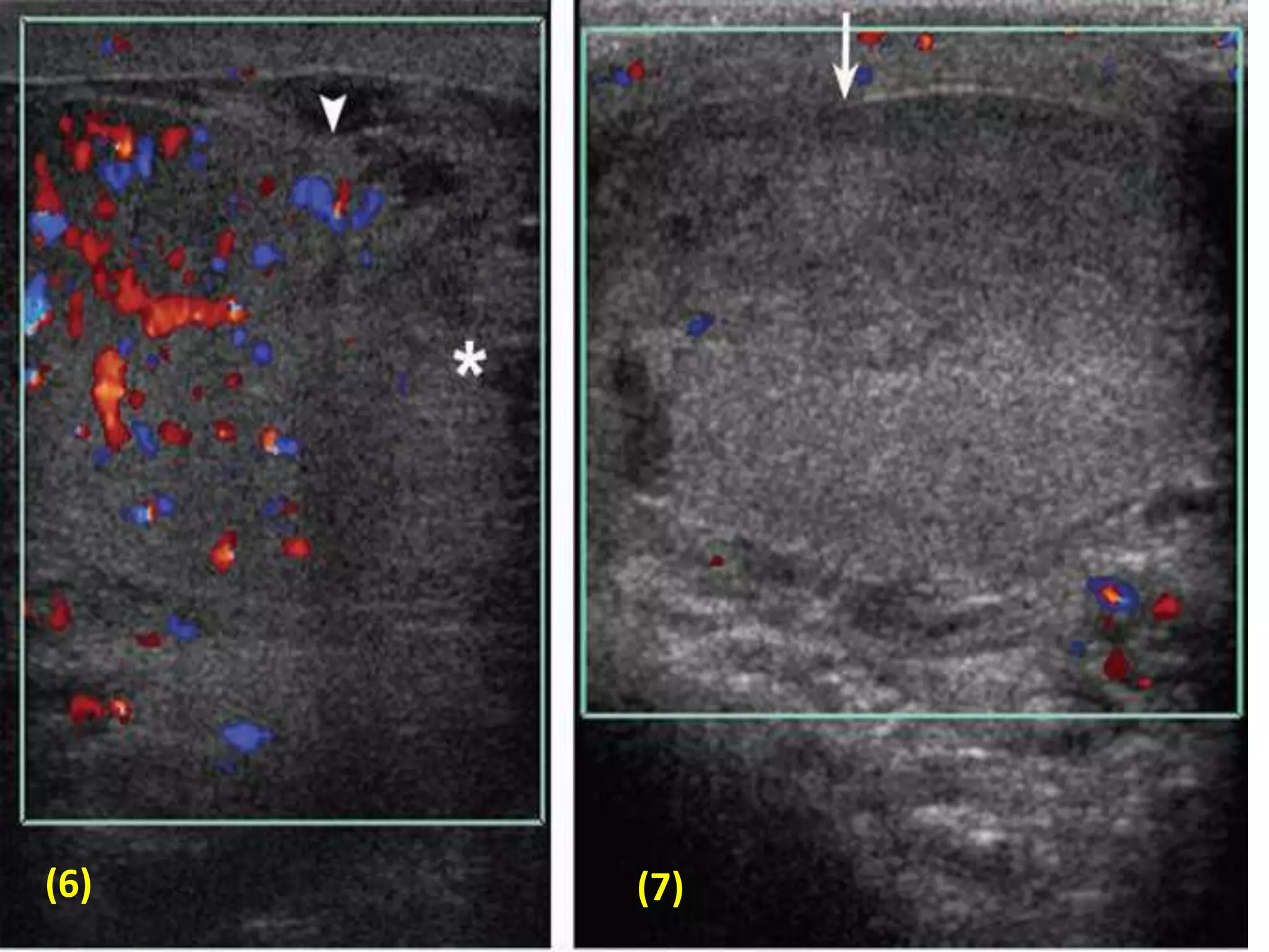 SCROTAL ULTRASOUND | PPTX