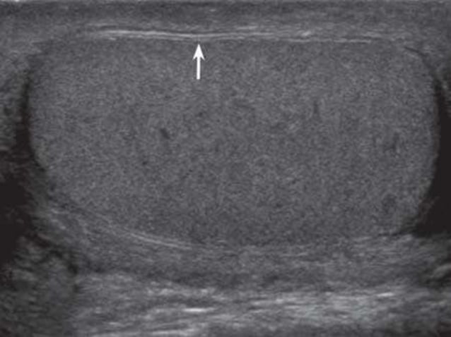 SCROTAL ULTRASOUND | PPTX | Medical Tests | Medical Health