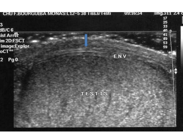 Scrotal Ultrasound Ppt