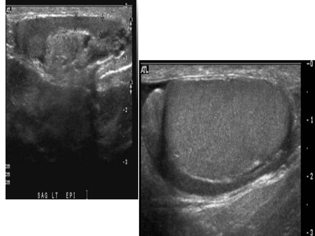SCROTAL ULTRASOUND | PPTX | Medical Tests | Medical Health
