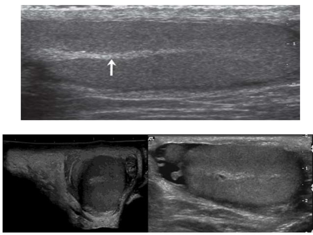 Scrotal Ultrasound Ppt