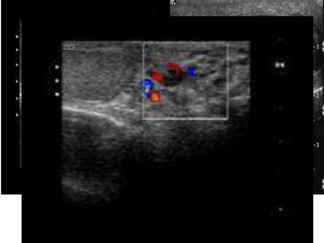 SCROTAL ULTRASOUND | PPTX | Medical Tests | Medical Health