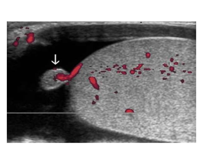 Scrotal Ultrasound Ppt