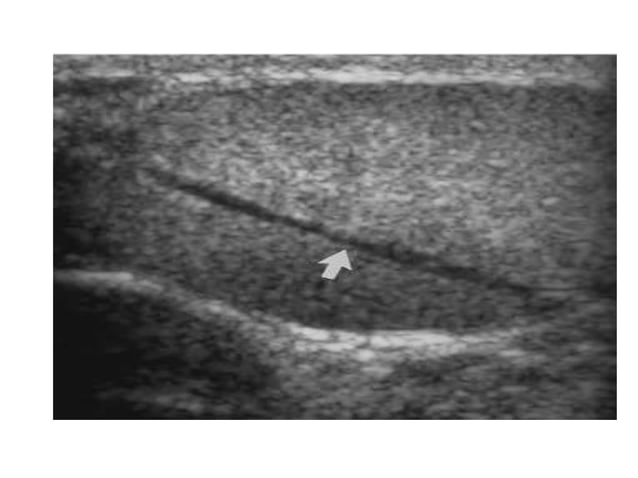 SCROTAL ULTRASOUND | PPTX | Medical Tests | Medical Health