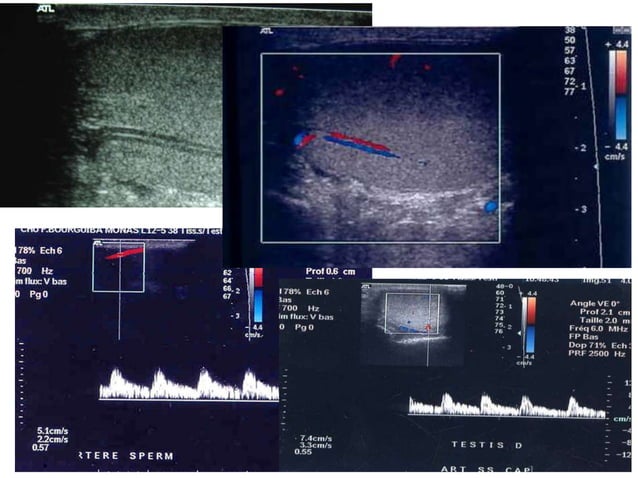 Scrotal Ultrasound Ppt