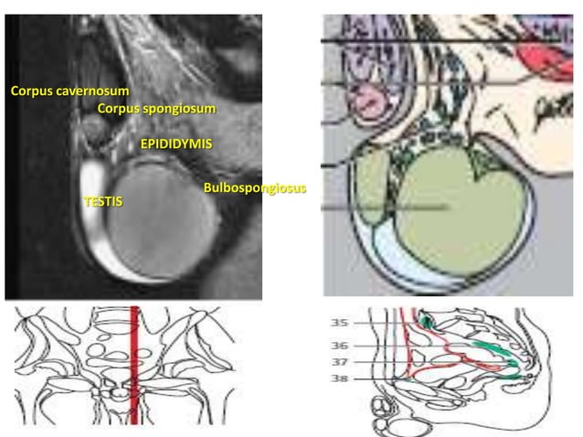 Scrotal Ultrasound Ppt