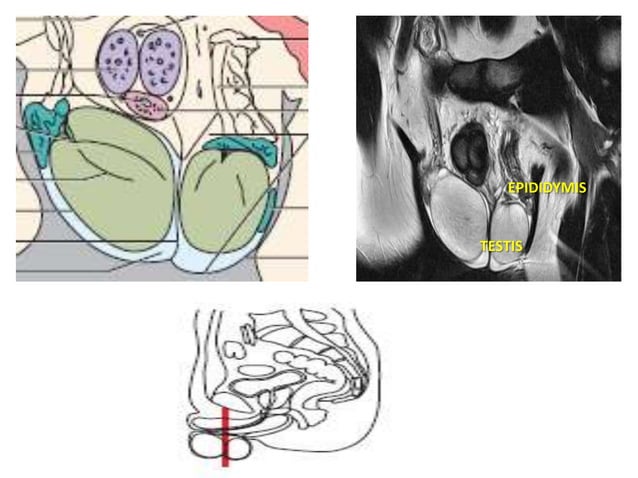 Scrotal Ultrasound Ppt
