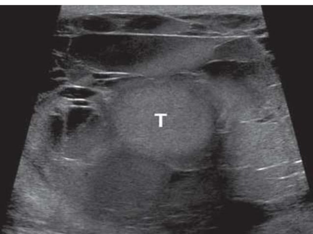 SCROTAL ULTRASOUND | PPTX | Medical Tests | Medical Health