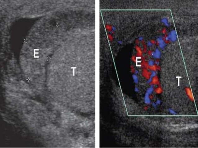 Scrotal Ultrasound Ppt