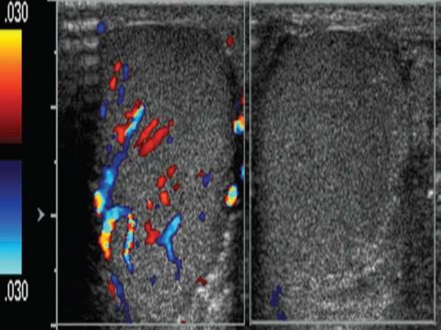 SCROTAL ULTRASOUND | PPTX | Medical Tests | Medical Health