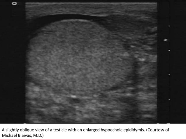 Scrotal Ultrasound Ppt