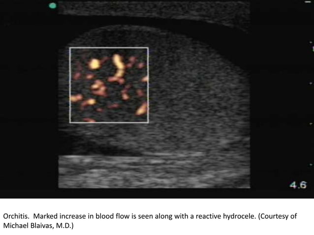Scrotal Ultrasound Ppt