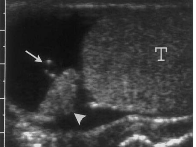 Scrotal Ultrasound Ppt