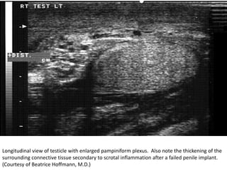 Pampiniform Plexus Ultrasound