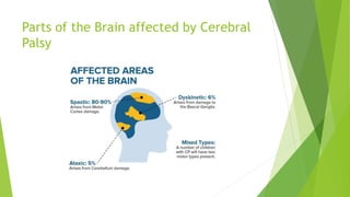 Understanding Neurobiology final project: Cerebral palsy | PPT