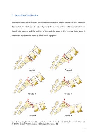 Spondylolisthesis | PDF